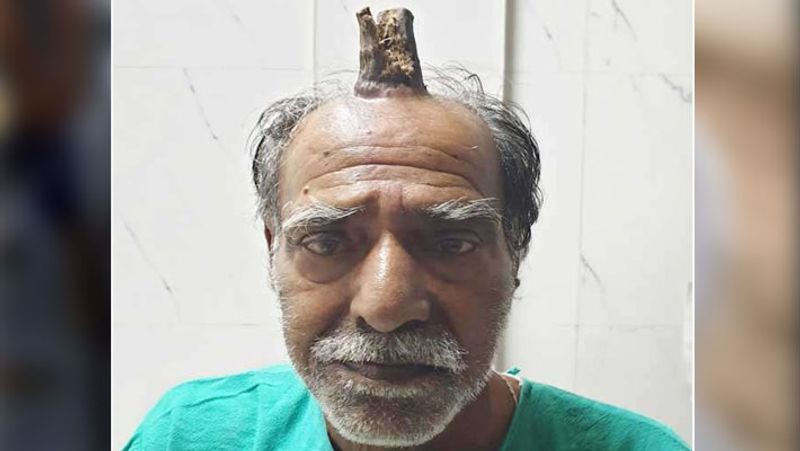 Rare case of sebaceous horn exposed in Madhya Pradesh, horn on head of ...