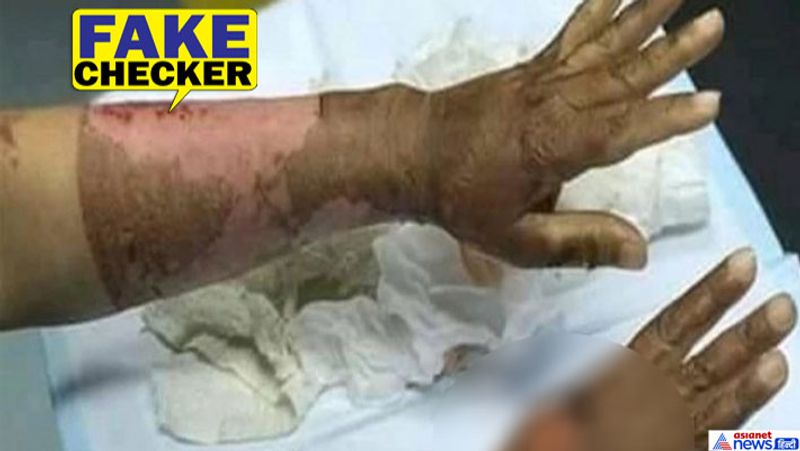 Corona Fact Check. शराब वाले सैनिटाइजर से जले महिला के हाथ, खबर पर यकीन ...