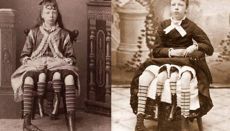 നാല് കാലുകളുമായി ജനിച്ച പെൺകുട്ടി, സർക്കസിലൂടെ പ്രശസ്‍ത, ഒടുവിൽ അവളുടെ ...