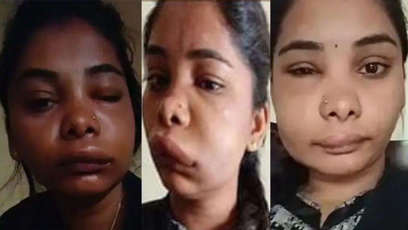 सर्जरी के बाद ऐसा बिगड़ा एक्ट्रेस का चेहरा कि पहचानना हुआ मुश्किल, अब ...