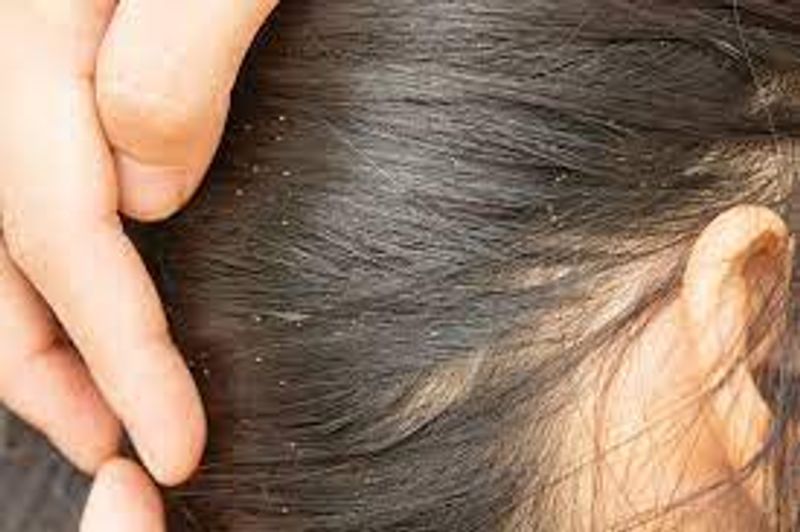 Head Lice Remedies : தலையில் பேன் தொல்லையால் அவதிப்படுகிறீர்களா..? ஒரே ...