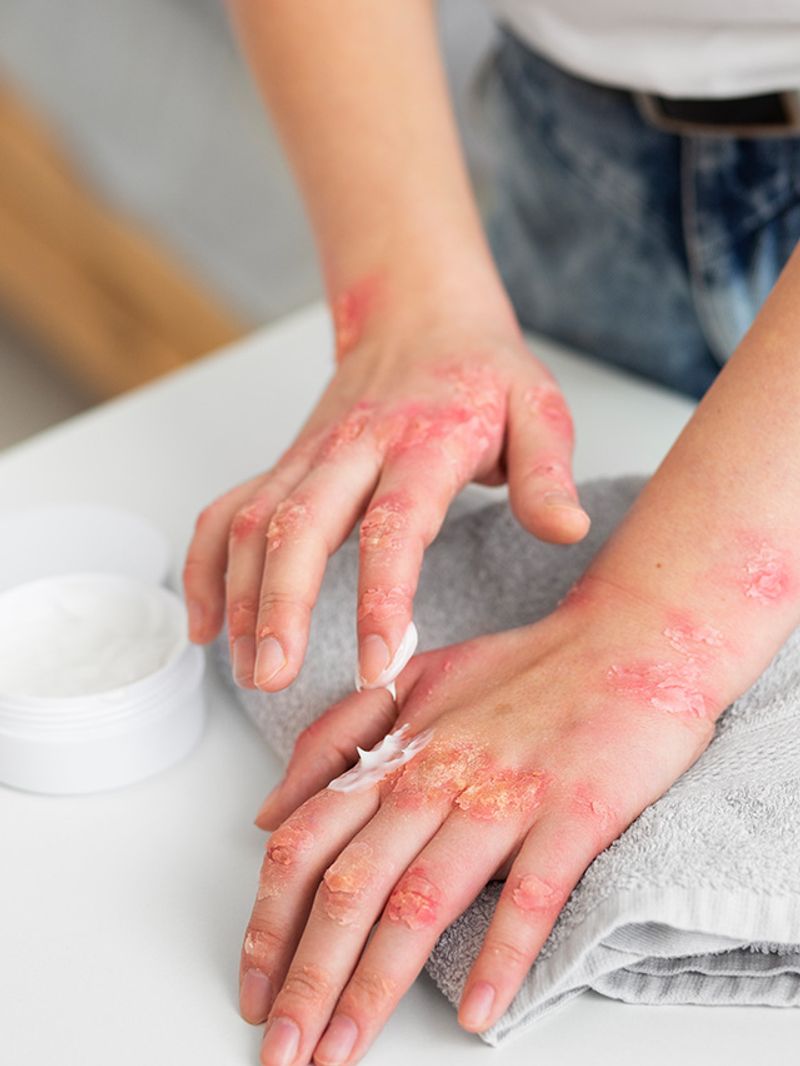 Here are 7 home remedies to battle summer skin rashes- Asianet News English