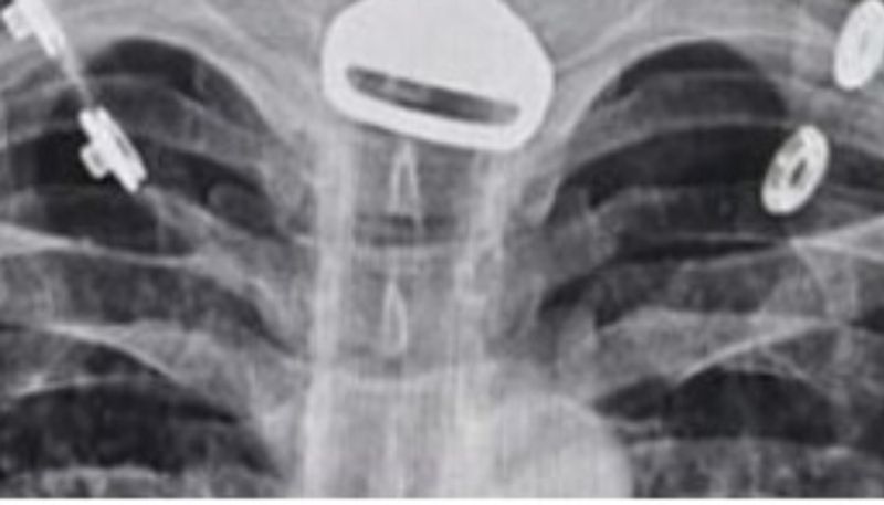 Shocking incident; Man swallowed car key കടുത്ത ശ്വാസംമുട്ടല് ...