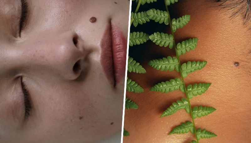 Unusual moles on your body? Here are 6 things which demands attention ...
