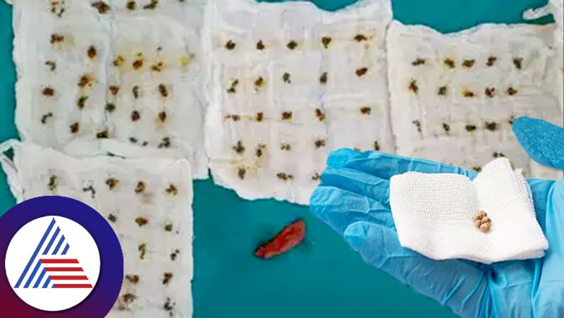 Gallstones: উচ্চমাধ্যমিক পরীক্ষার্থীর গলব্লাডারে প্রায় ৪,০০০ স্টোন ...