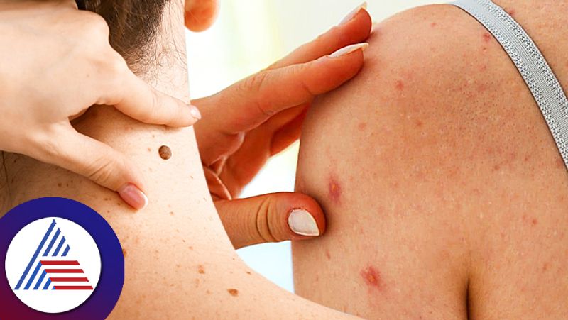 ಯಾವುದೇ ಕಾರಣ ಇಲ್ಲದೇ ದೇಹದ ಮೇಲೆ ಗಾಯದ ಗುರುತು ಕಾಣಿಸೋದು ಯಾಕೆ? - Why a blue ...