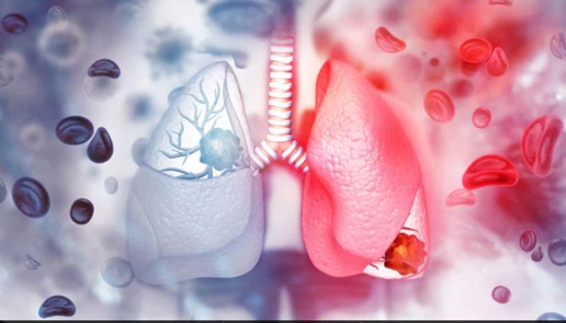 Lung Disease: Here are some warning signs one needs to check out ...