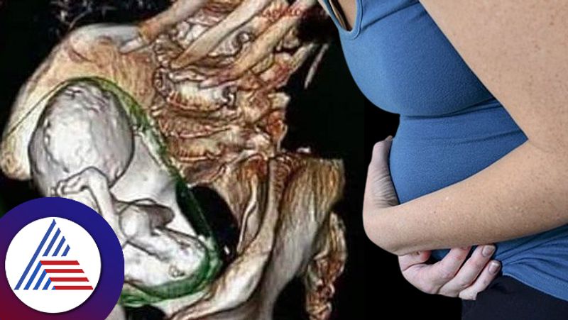 73ರ ಮಹಿಳೆ ಗರ್ಭದಲ್ಲಿ 35 ವರ್ಷದ 'ಮಗು'! ಹೊಟ್ಟೆ ನೋವೆಂದು ಆಸ್ಪತ್ರೆಗೆ ಹೋದಾಗ ...