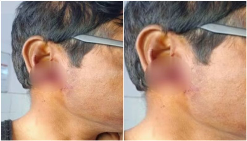 woman bites off man's ear and swallow ആദ്യം തർക്കം, പിന്നാലെ രോഷാകുലയായ ...