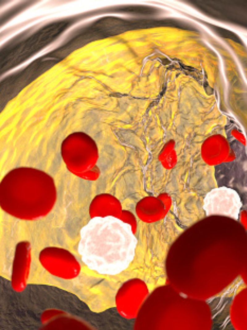 tips to remove bad ldl cholesterol from body rsl | Tips To Remove Bad ...