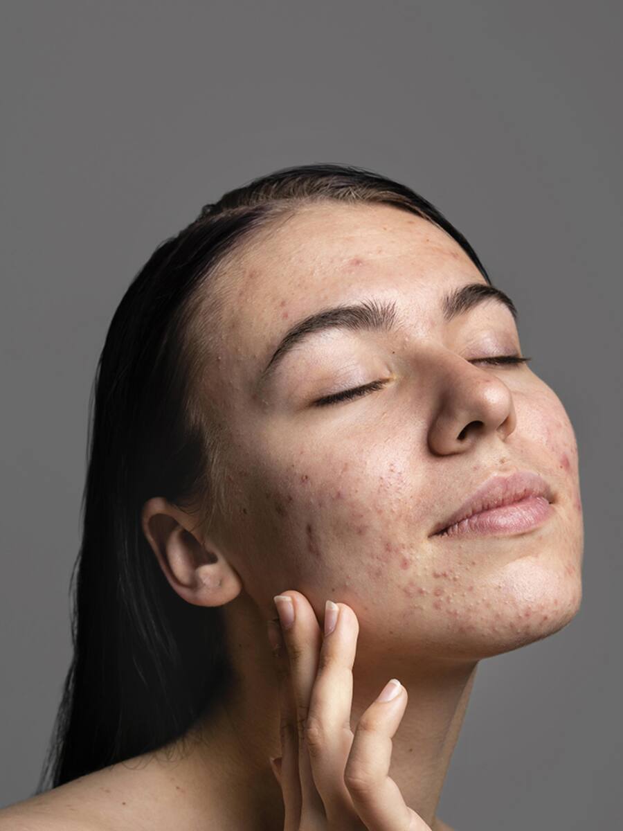 पस भरे एक्ने और पिंपल से छुटकारा दिला देंगी किचन की ये 7 चीजें Skin