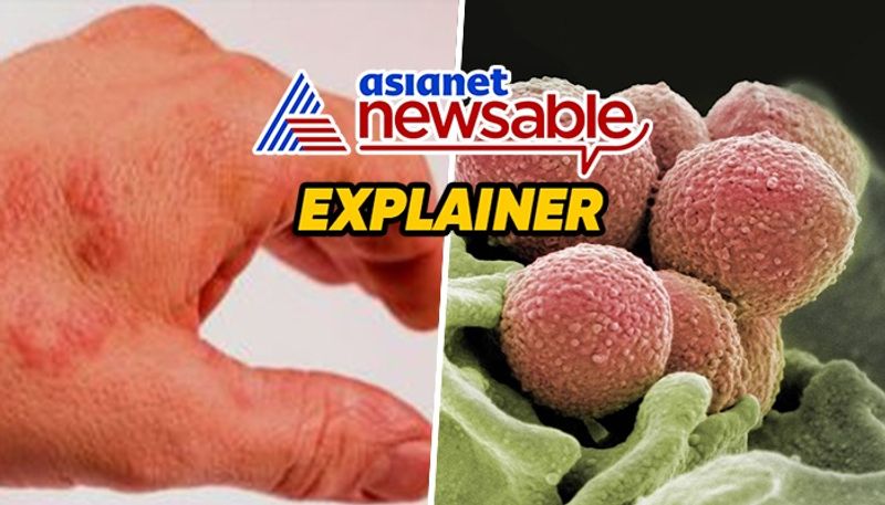Explained: What is STSS, deadly 'flesh-eating bacteria' spreading in ...