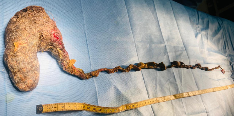 Rare condition treated successfully in 9 year old girl with ...