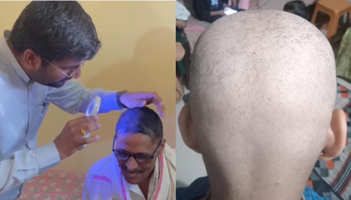 Buldhana hair loss selenium in wheat ಬಯಲಾಯ್ತ ಬುಲ್ದಾನ ಹೇರ್‌ ಫಾಲ್‌ ಕೇಸ್ ...