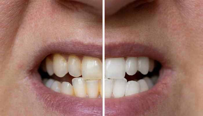 ಬಾಯಿಯಿಂದ ದುರ್ವಾಸನೆ ಬರ್ತಿದ್ದರೆ, ಹಲ್ಲು ಹಳದಿಯಾಗಿದ್ದರೆ ಈ ಸುಲಭ ಮಾರ್ಗ ಟ್ರೈ ...