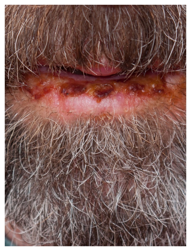 Lips Cancer: జాగ్రత్త.. పెదవి క్యాన్సర్ ఉంటే ఈ లక్షణాలు ఉంటాయట.. | Lip ...