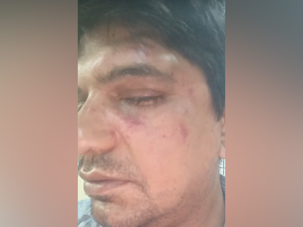 Professor assaulted in Bengaluru for stopping littering; suffers facial ...
